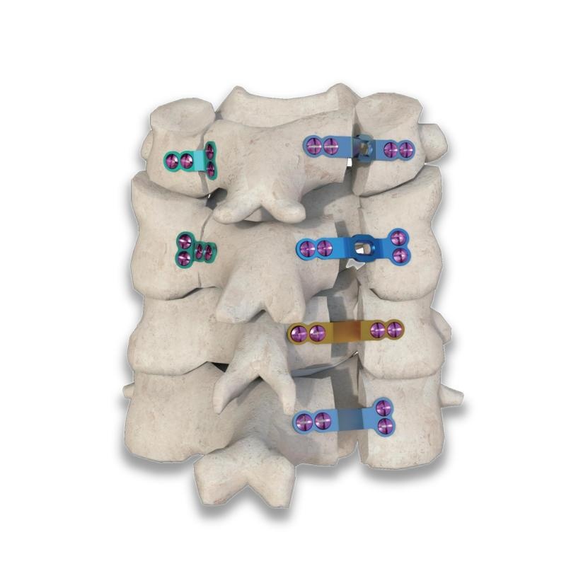Spine cone and plate fixation systerm